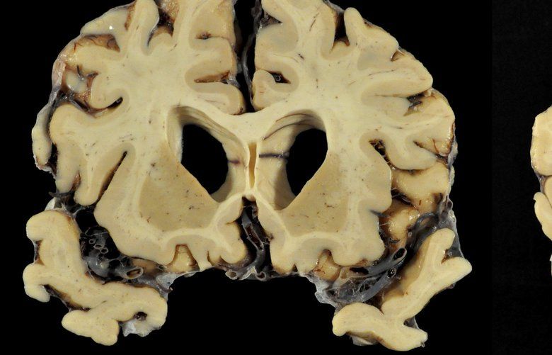 Science Says: How repeated head blows affect the brain | The Seattle Times