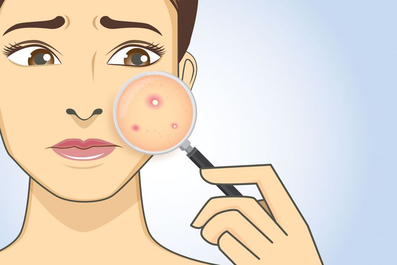 Pimple Clipart
