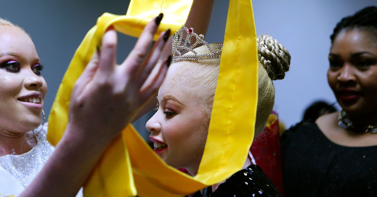 Albinism pageant in Zimbabwe joyfully breaks down prejudice | The ...