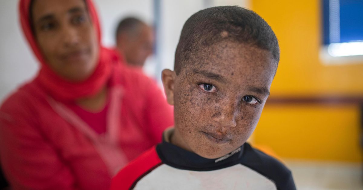 When light is lethal: Moroccans struggle with skin disorder | The ...