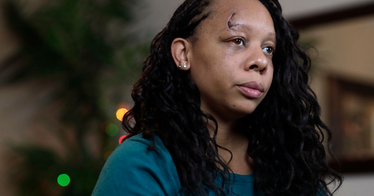 Protester hit in face by police rubber bullet wants answers | The ...