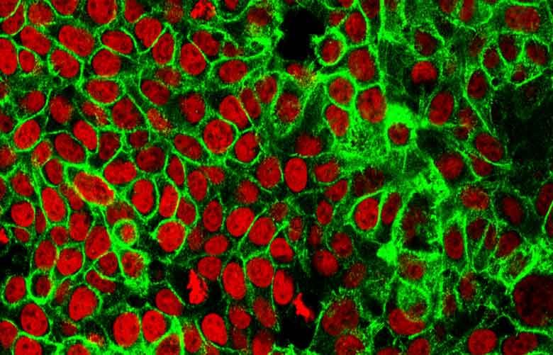 Colon cancer rates are spiking among young people. Here’s why, and how ...