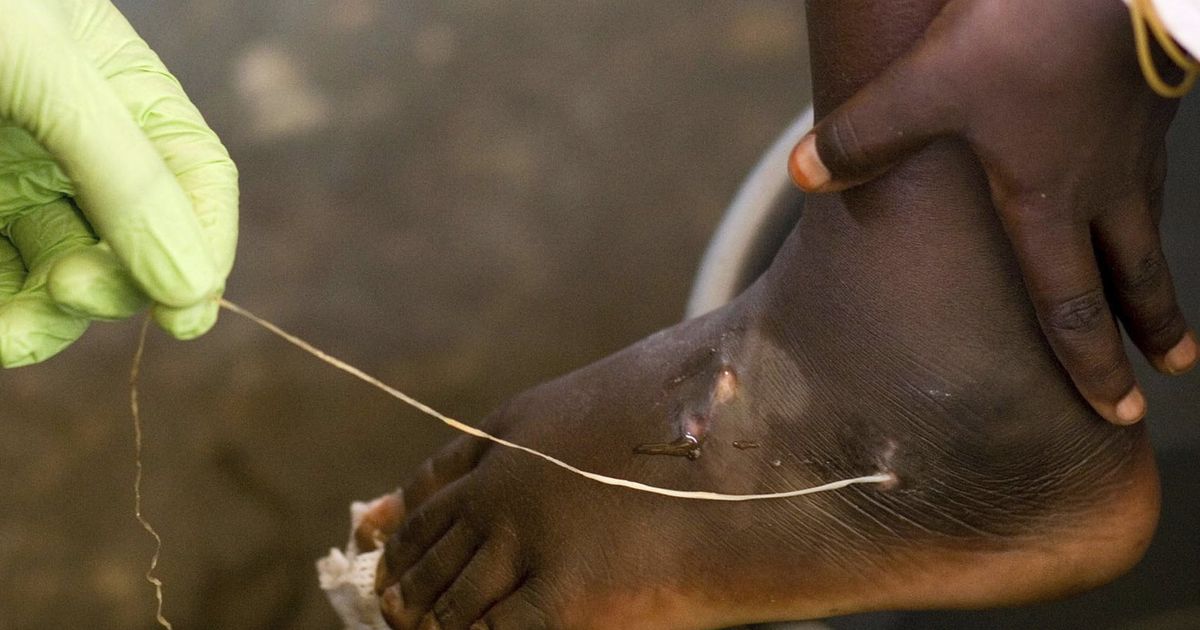 Jimmy Carter’s dream, almost reached: Guinea worm cases drop to 14 ...
