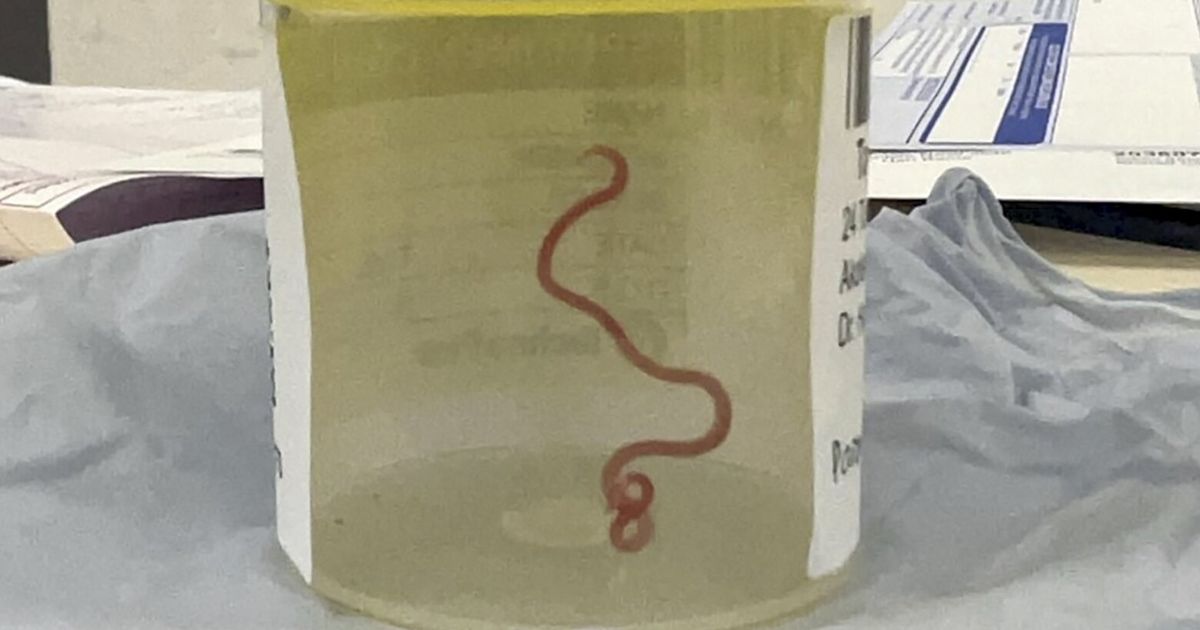 Neurosurgeon investigating patient’s mystery symptoms plucks a worm ...