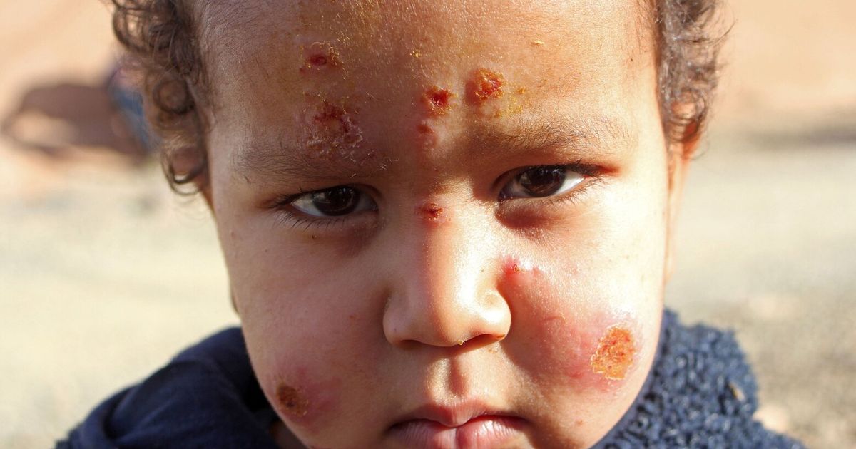 Texas sand fly may carry parasites that cause disfiguring skin disease ...