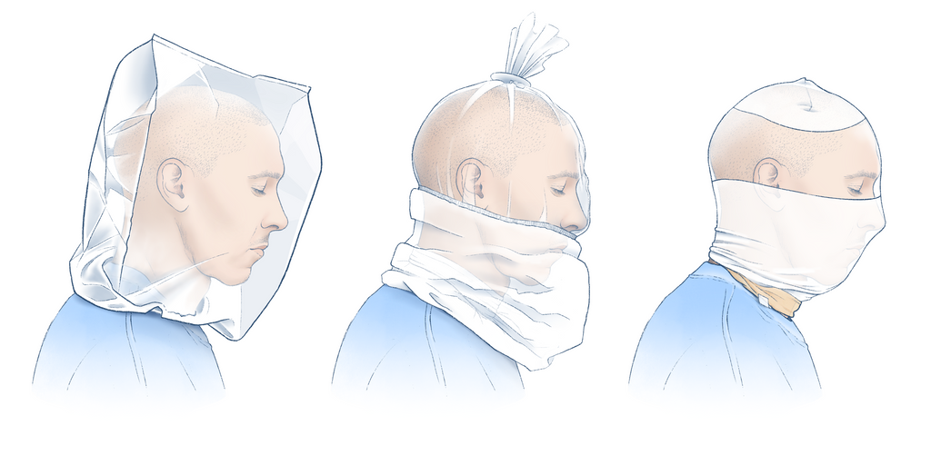 Where and how spit hoods are used across the U.S. | The Seattle Times