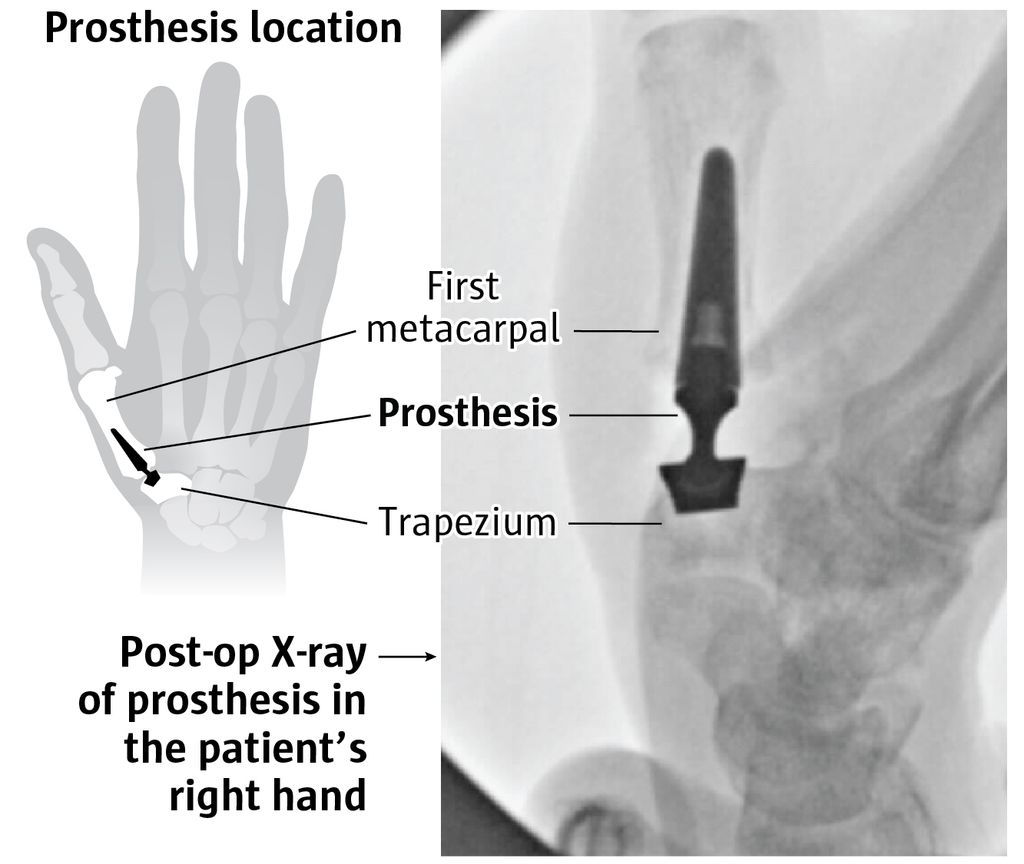 Seattle doctor becomes first in PNW to perform new thumb surgery | The ...