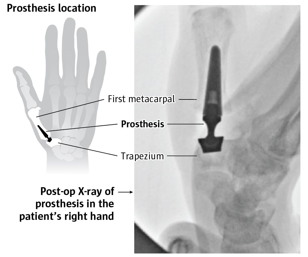 Seattle doctor becomes first in PNW to perform new thumb surgery | The ...